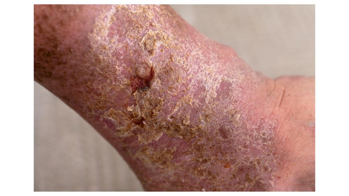 Diabetic Foot Ulcer vs. Venous Stasis Ulcer: – Corecare Health